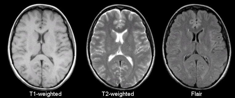 Understanding MRI Assessments: T1, T2, STIR, and More - Genspark