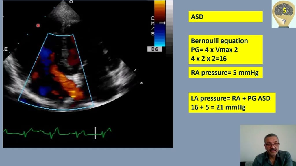 Understanding Left Atrial Pressure Using Echocardiography - Genspark