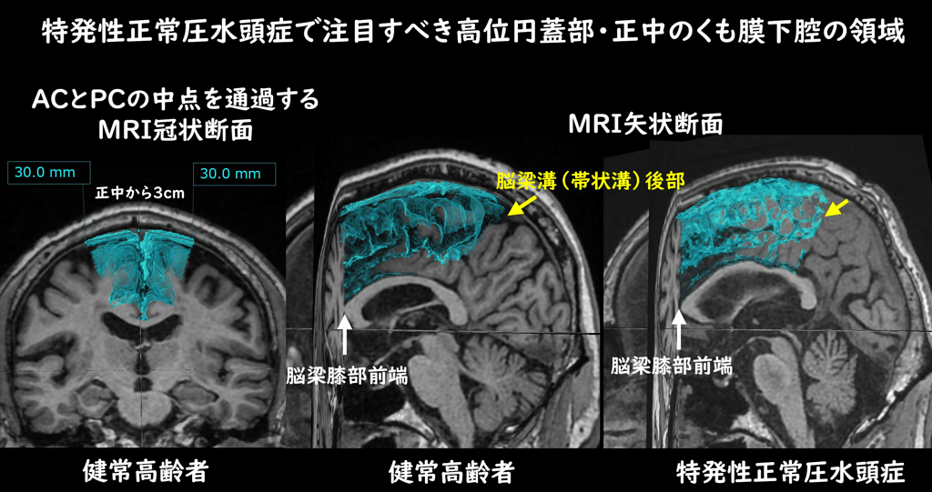 ISFETカテーテルによる脳のpH測定 - Genspark