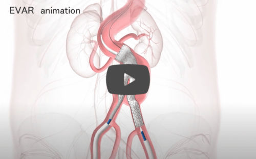 心臓血管外科手術におけるEVARの概要 - Genspark