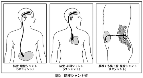 VPシャントについての基本情報 - Genspark