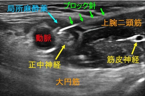 伝達麻酔と腕神経叢ブロックの概要 - Genspark